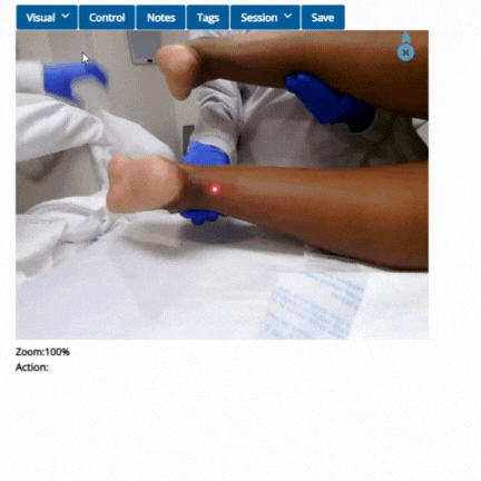 WoundVision Scout + Now Integrated with the Monk Skin Tone (MST) Scale